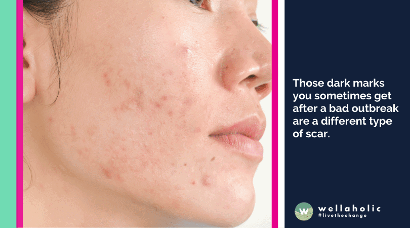 Effective Treatment Against Acne Scars - Your Total Guide - Wellaholic